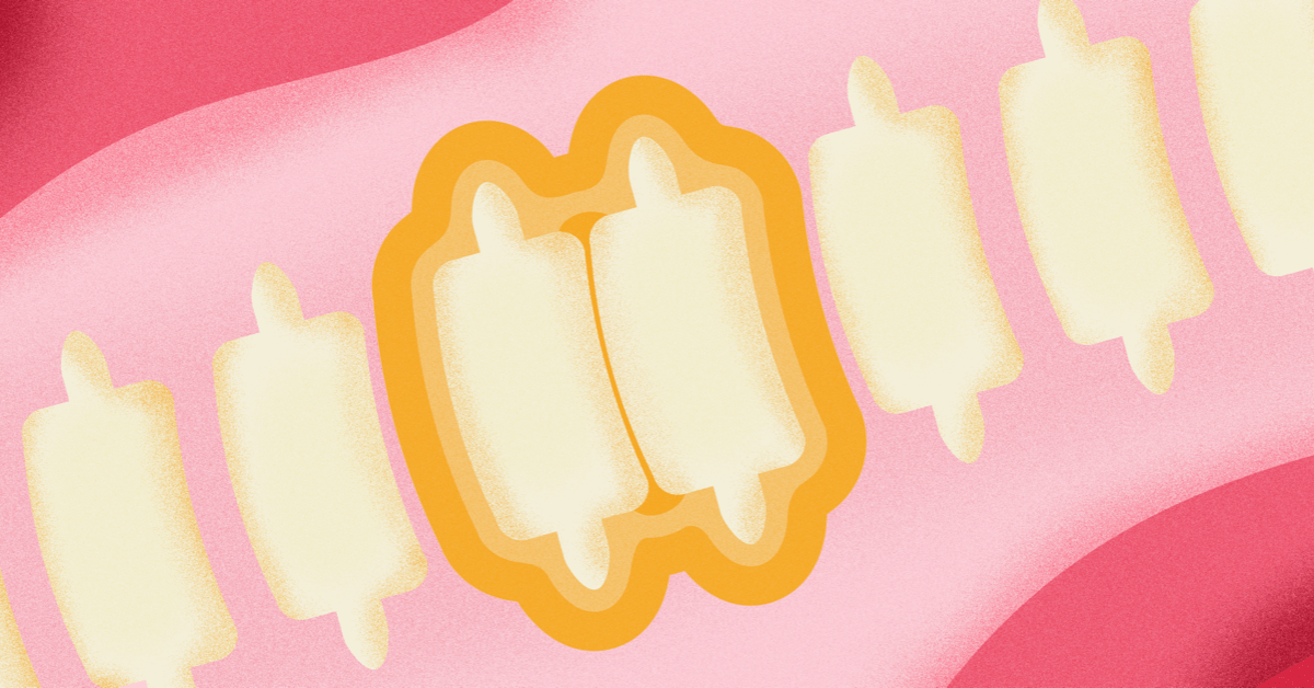 Bone Fusion and Range of Motion Loss in Rheumatoid Arthritis